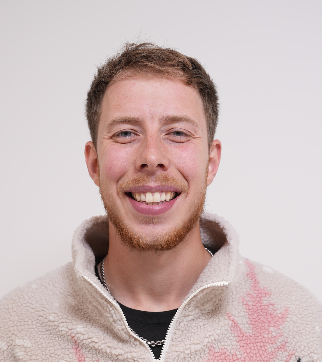 Exploring the Calfreezy Hair Transplant Speculation | HairSimulate